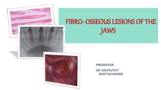 Keratocystic odontogenic tumors(KCOT) or Odontogenic Keratocyst(OKC)OKC ...