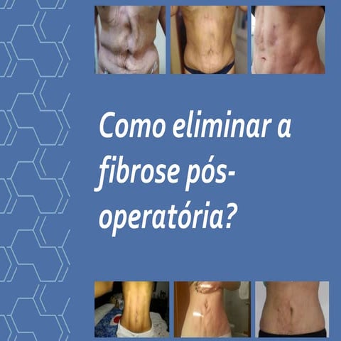 Fibrose | PPSX