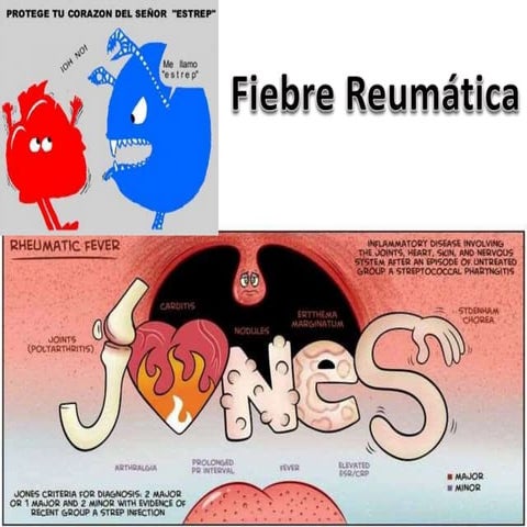 Fiebre reumatica | PPTX | Heart and Cardiovascular Diseases | Diseases ...