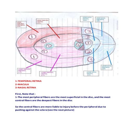 Field changes in glaucoma | DOC | Eye and Vision Conditions | Diseases ...