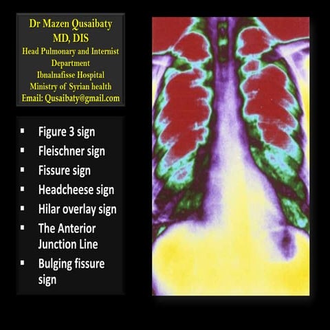 Bulging Fissure Sign The Radiology Assistant : Chest X Ray Lung