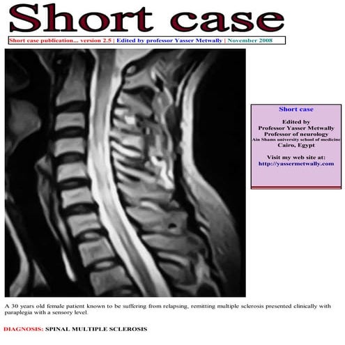 Short case...Spinal multiple sclerosis | PDF