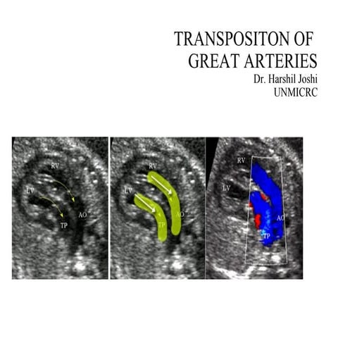Transposition of Great Arteries | PPT