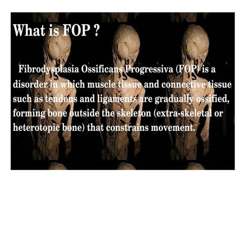 Fibrodysplasia ossificans progressiva | PDF