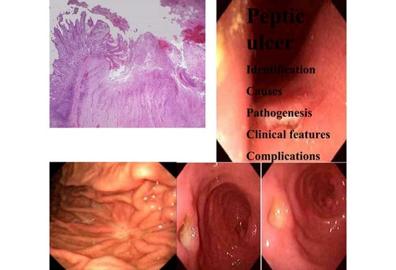 Pathophysiology of Peptic ulcer | PDF