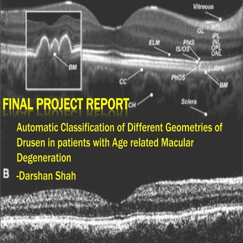 Automatic Drusen Classification | PPTX | Eye and Vision Conditions | Diseases and Conditions