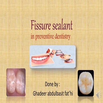 Fissure sealant | PPTX