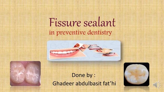 Pit and Fissure sealants | PPTX