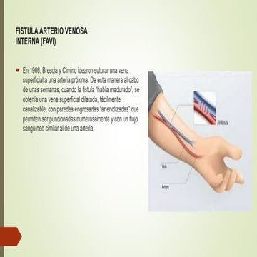 FISTULA ARTERIO VENOSA INTERNA (FAVI) (1).pptx