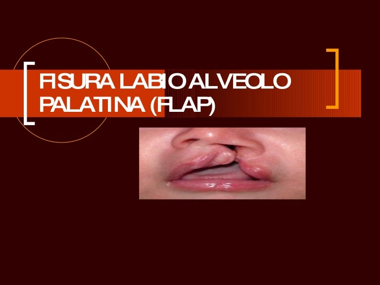 Fisura Labio-Alvéolo-Palatina – KQSHG