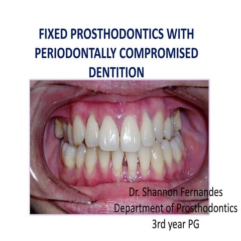 Fixed prosthodontics with periodontally compromised dentition | PPTX