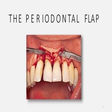 Frenectomy | PPTX
