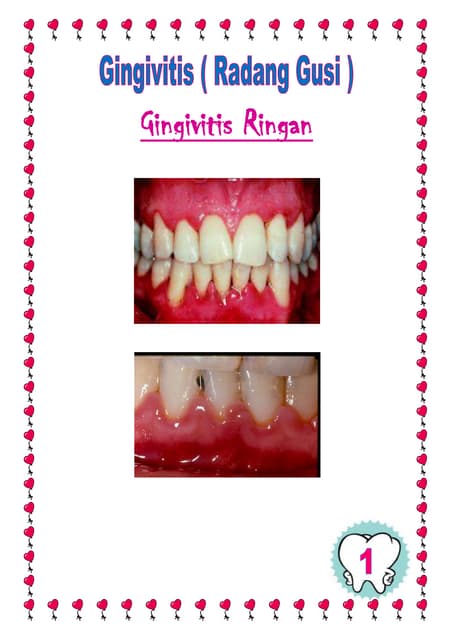 Keterangan gingivitis | DOCX