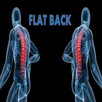 Flat back syndrome | PPTX