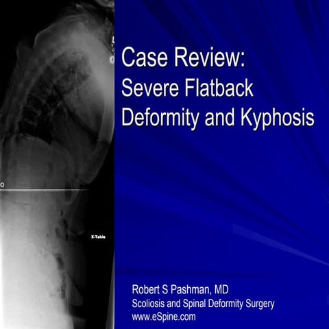 Case Review #2: 66 year old female with severe Flatback Syndrome | PDF