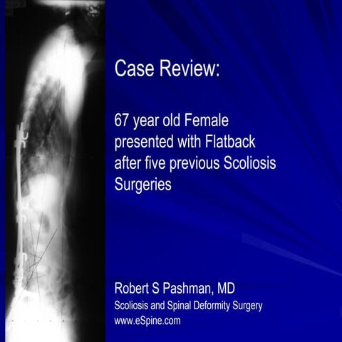 Case Review #5: 67 year old woman with flatback syndrome following 5 ...