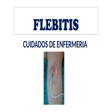 TIPOS DE FLEBITIS Y CUIDADOS DE ENFERMERÍA | PPTX
