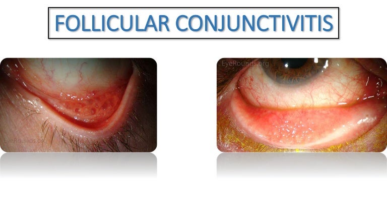 Follicular conjunctivitis (1) Follicular conjunctivitis (1)