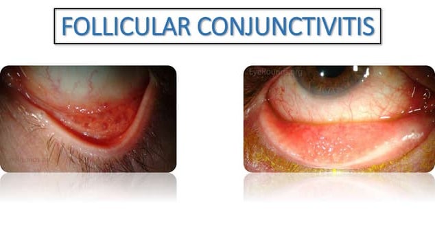 Angular Conjunctivitis