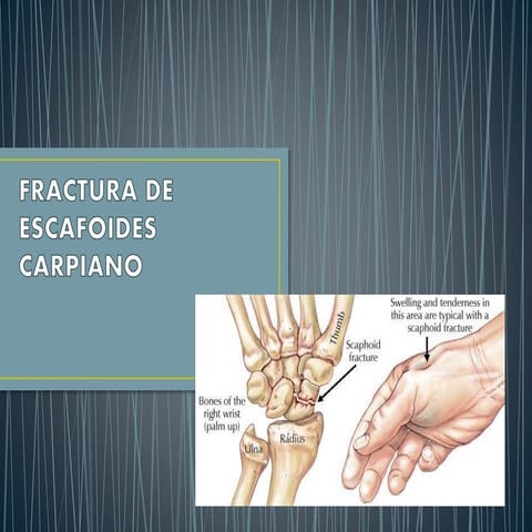 Fractura del carpo traumatologia aplicada | PPT