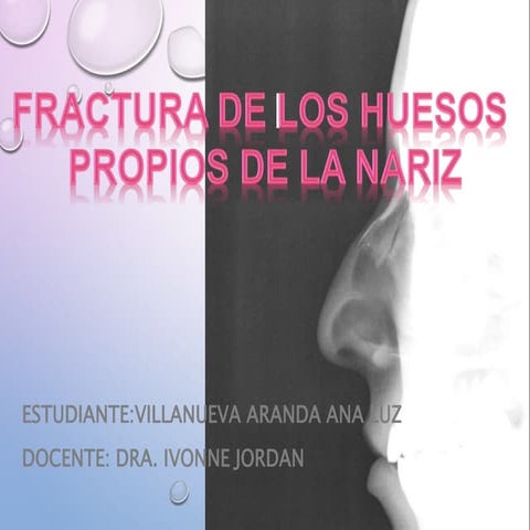 Fractura-de-los-huesos-propios-de-la-nariz | PPT