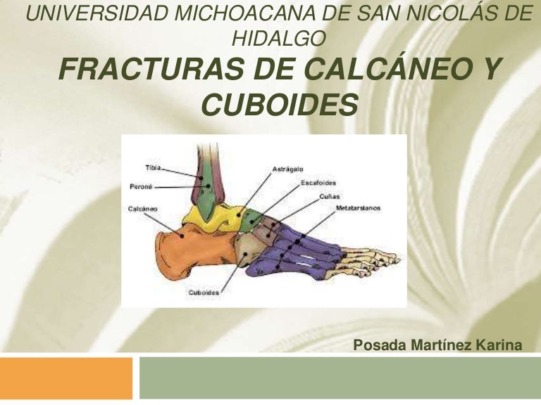 Fractura de cuboides y calcáneo