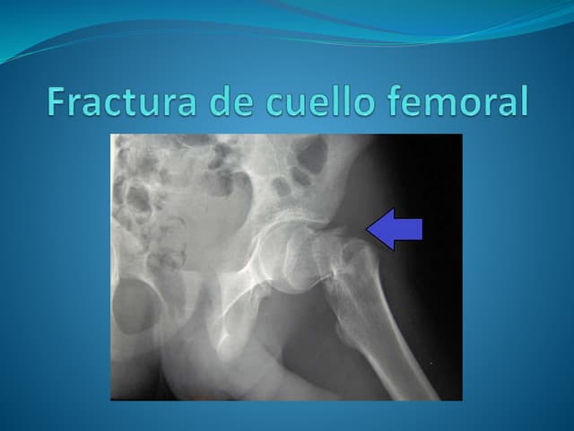 Fractura De Cuello Femoral Ppt