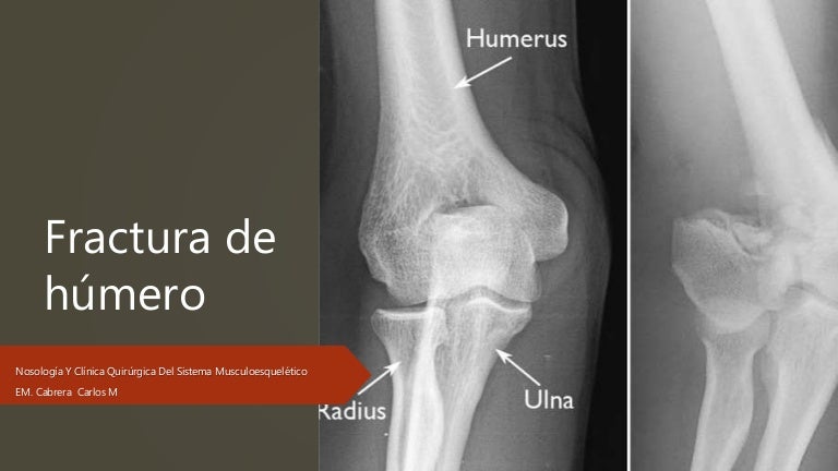 Fracturas de Humero