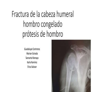 Fractura de la cabeza humeral | PPTX