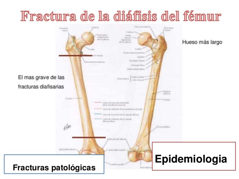 Fractura de la diafisis femoral