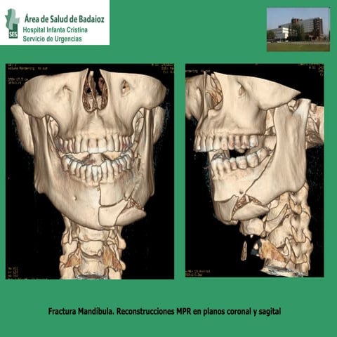 Fractura de mandibula[Dr. Juanjo Arroyo] | PPS