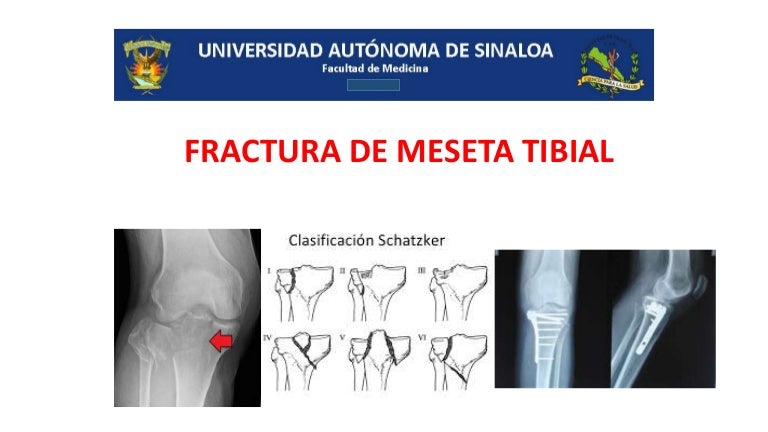 Fractura de meseta tibial