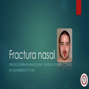 10 fractura nasal y septal | PPTX