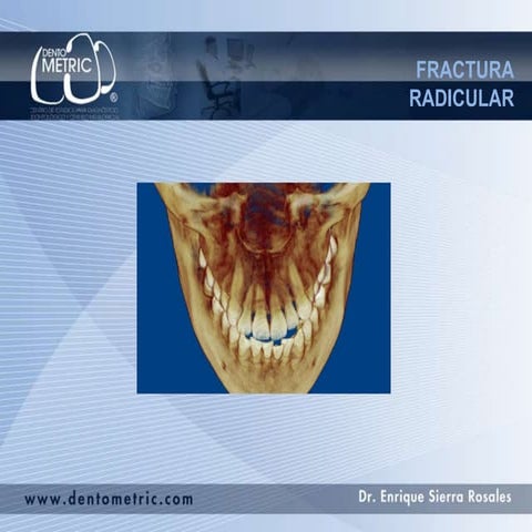 Fractura radicular | PPTX