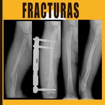 Tipos Y Tratamiento De Fracturas óseas Ppt
