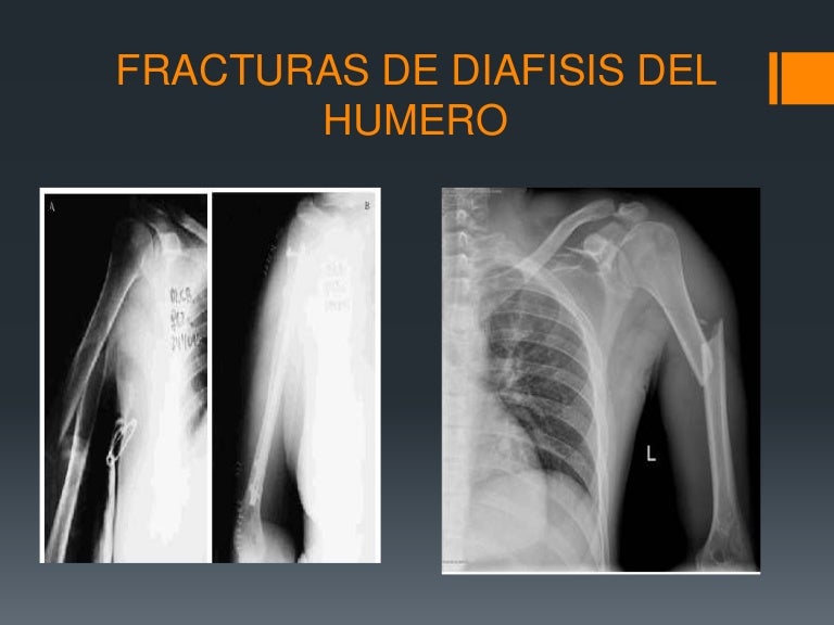 Fracturas de diafisis del humero