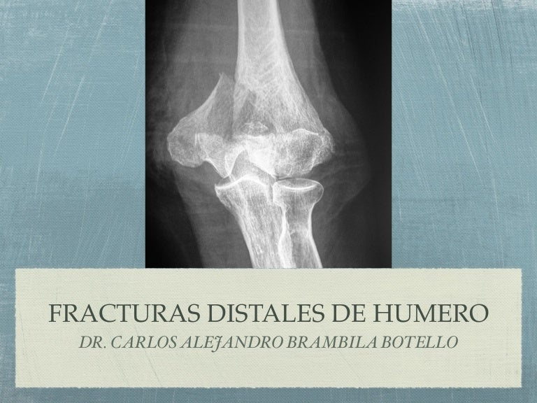 Fractura De Humero Fractura De Humero