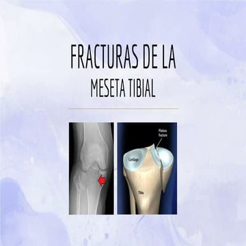 FRACTURAS DE LA MESETA TIBIAL c.pptx
