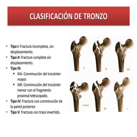 Fracturas Intertrocanterias Clasificación De Tronzo Y Tratamiento Pptx