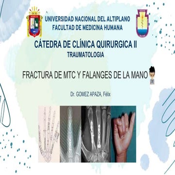 Fractura de MTC y falanges de la mano | PPTX