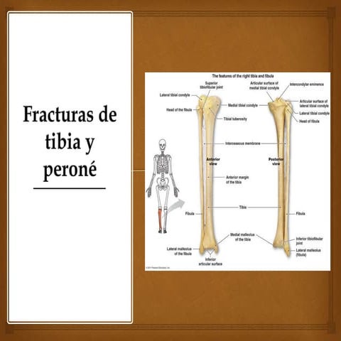 Fracturas de Tibia y peroné | PPTX