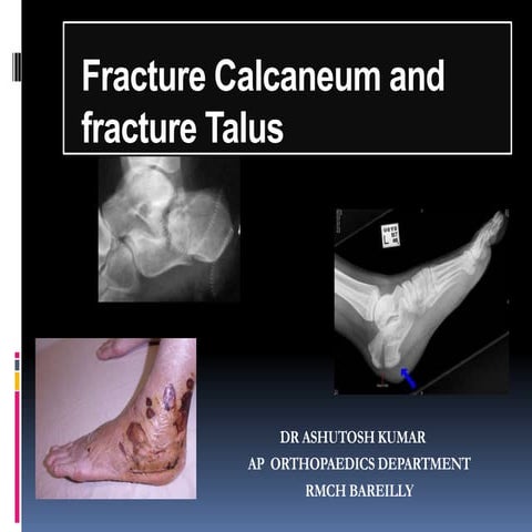 Talus Avulsion Fracture