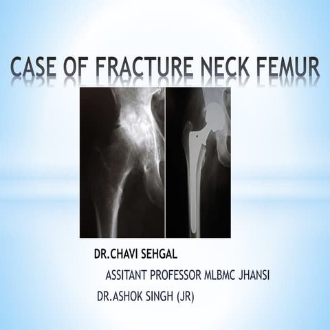 Fracture neck femur | PPTX