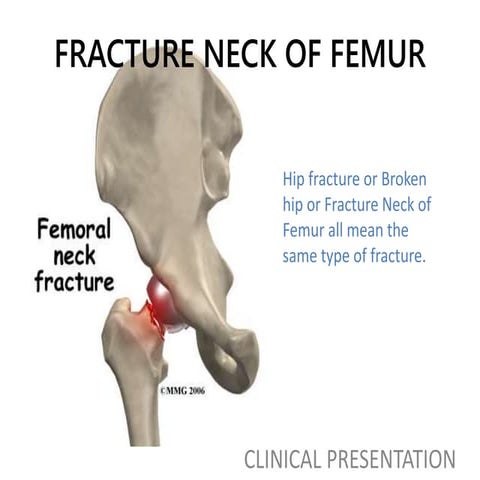 Fracture neck of femur | PPTX