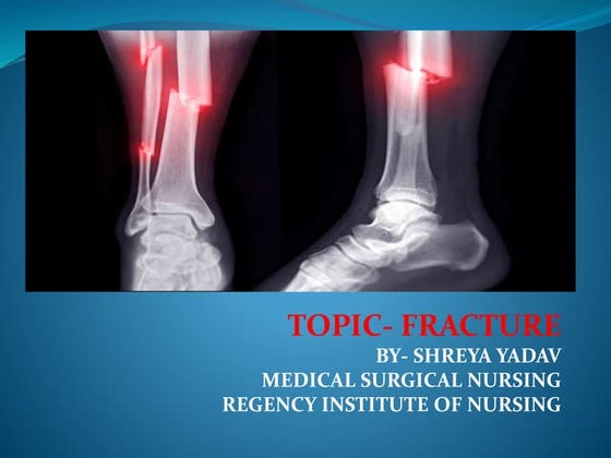 Basic Principles of Fracture Management | PPT