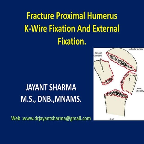 Fracture proximal humerus Fixation with K wires and External fixator | PPTX