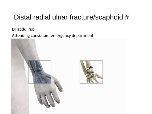 Distal End Radius Fractures - Colles, Smiths & Bartons | PPTX