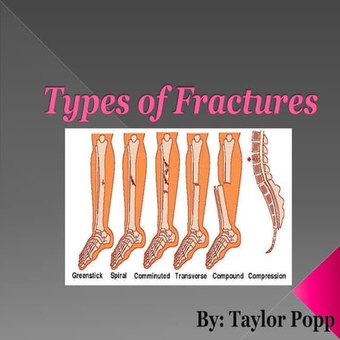 Types Of Fractures | PPTX