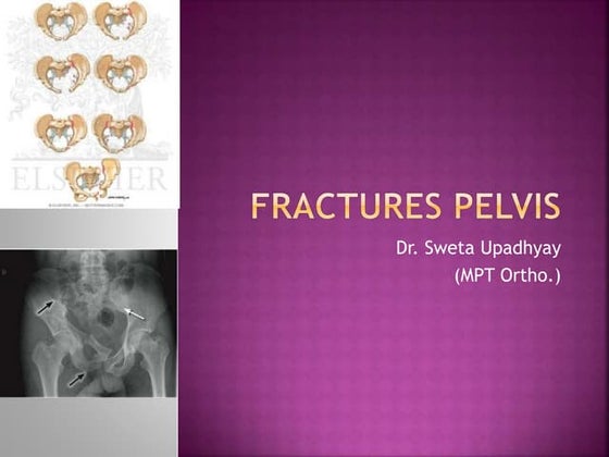 FRACTURES OF THE PELVIS-1.ppt