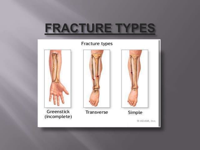 Types of Fractures | PPTX